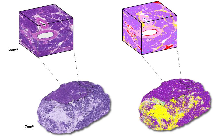 3D Pathology using AI – Wirtz/Wu Lab
